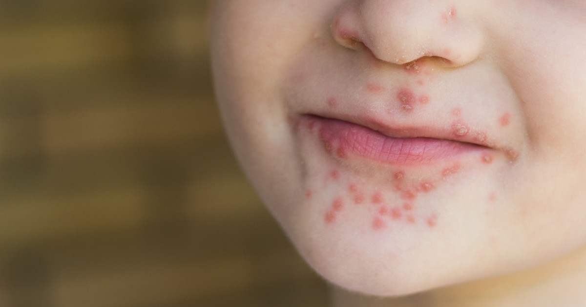 Lekarka: bostonka jest z nami od zawsze, prawie każde dziecko zachoruje