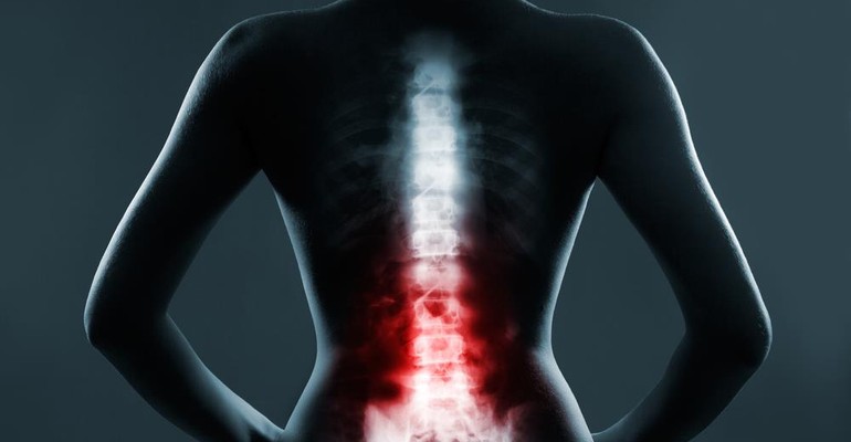 Skolioza - objawy, leczenie, operacja. Ćwiczenia na skoliozę [WYJAŚNIAMY]