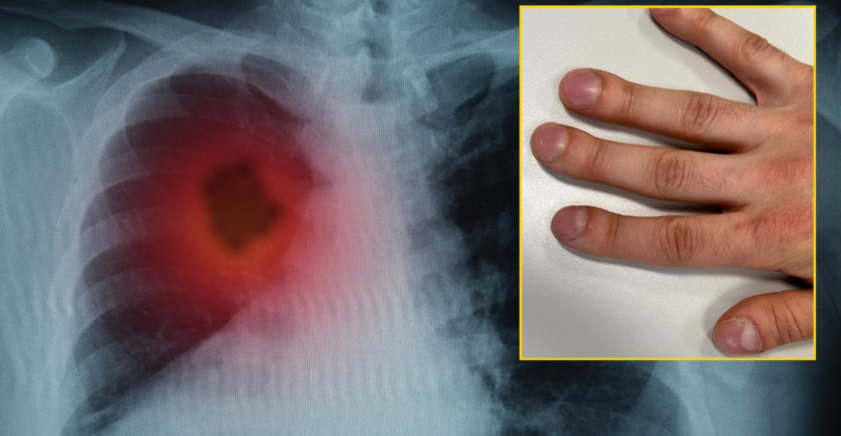 "Palce pałeczkowate" zwiastują raka płuc? Objaw występuje u prawie 40 ...
