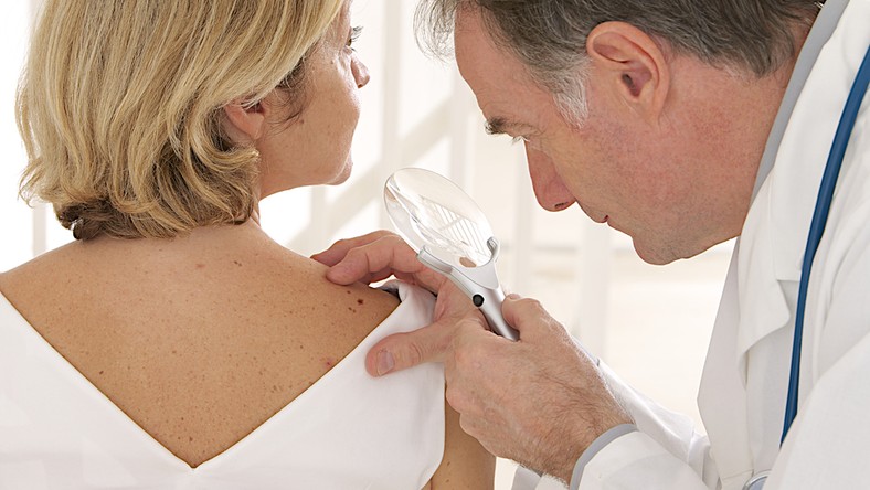 Rak skóry - objawy, rodzaje i leczenie - Zdrowie