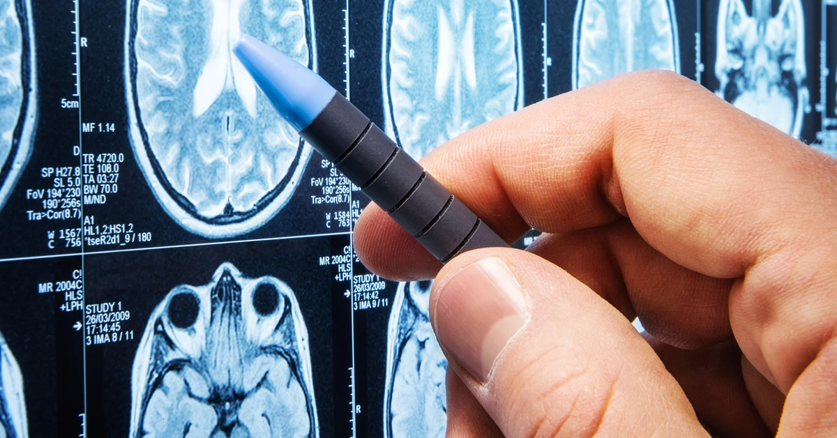 Nowa bardziej skuteczna metoda leczenia glejaka opracowana przez ...