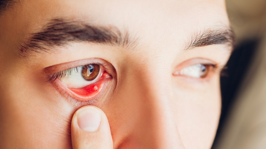 Árpa a szemen: ilyen tünetek mellett már mindenképp forduljon orvoshoz! | EgészségKalauz