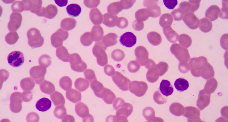 Limfocyty - powyżej i poniżej normy (podwyższone i obniżone)