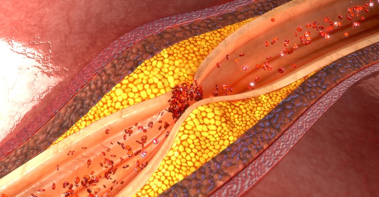 Homocysteina - normy, badanie, wskazania do badania. Jak obniżyć poziom ...