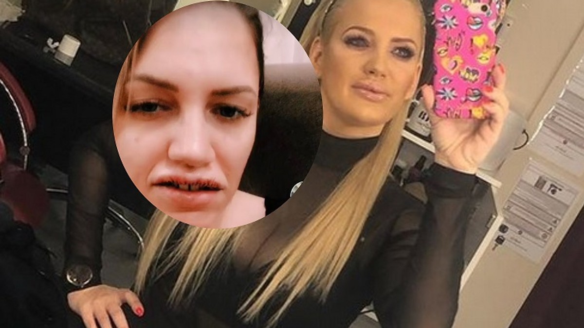 sanja stojanovic usne biopolimer operacija - Blic