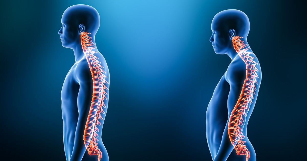 Lordoza - rodzaje, przyczyny, objawy. Profilaktyka lordozy