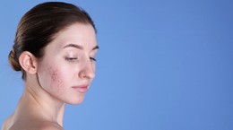 Axotret na trądzik - skład, dawkowanie, wskazania, przeciwwskazania ...