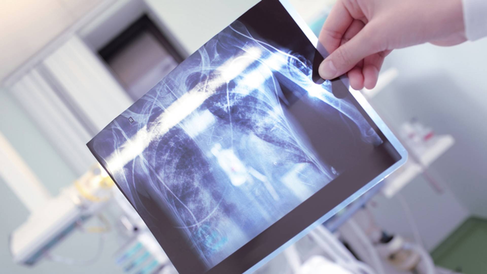 Sarkoidoza - objawy, przyczyny, leczenie | Ofeminin