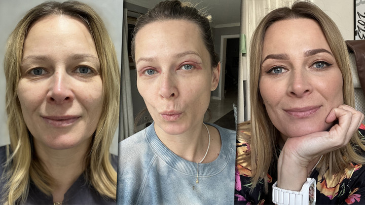 Odeta Moro pokazała, jak wygląda po operacji powiek. "Dwa razy ...