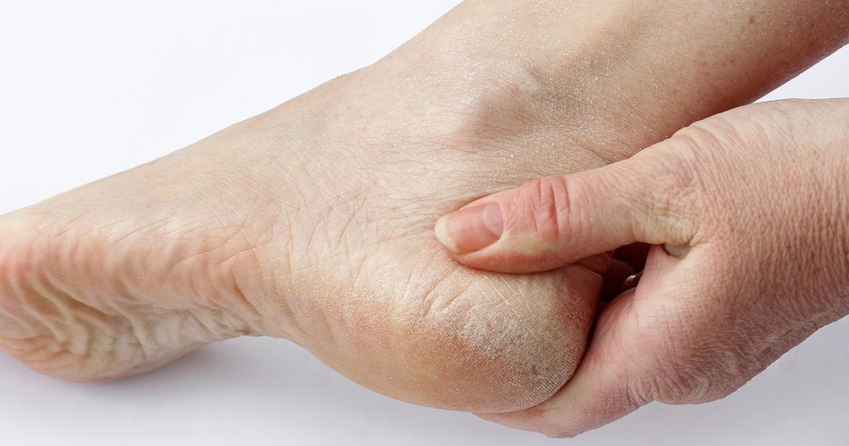 Modzele i odciski na stopie - różnice, usuwanie i leczenie