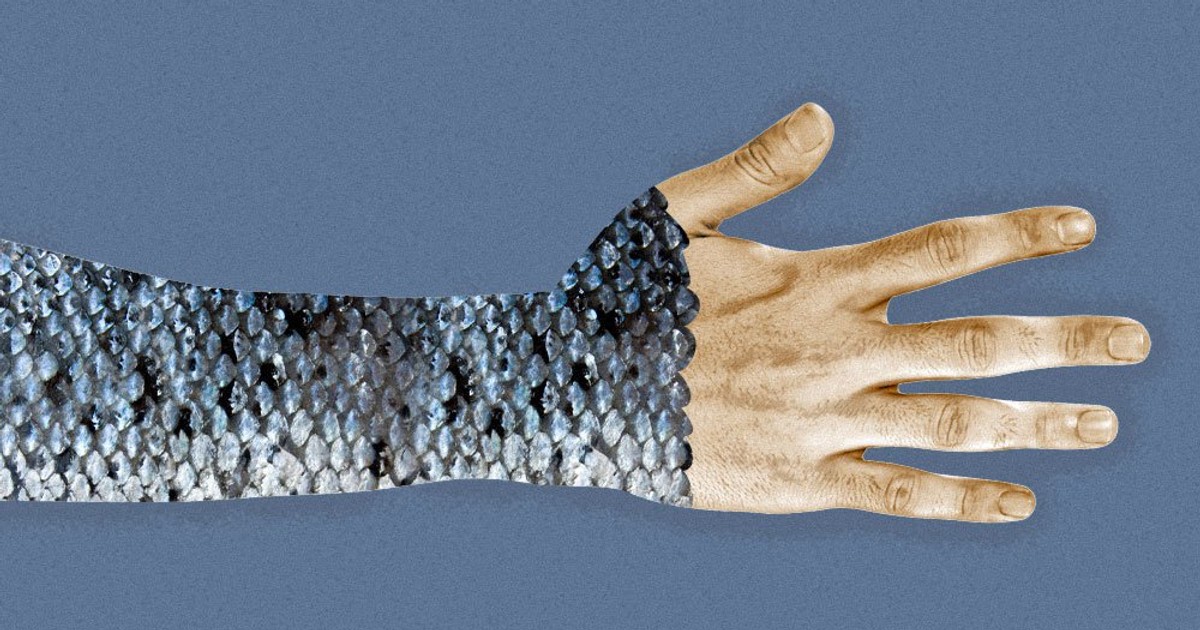 Can you bandage burns with fish skin? | Pulse Ghana