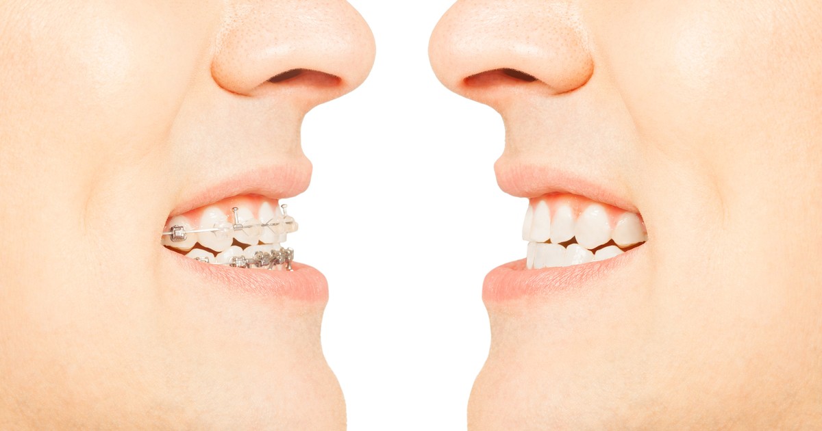 Progenia - objawy, operacja, progenia u dziecka - Zdrowie