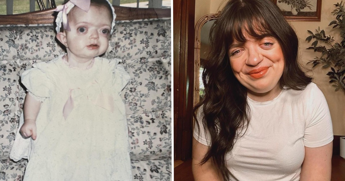 I spent years trying to hide my face. Today, I'm a proud woman who ...