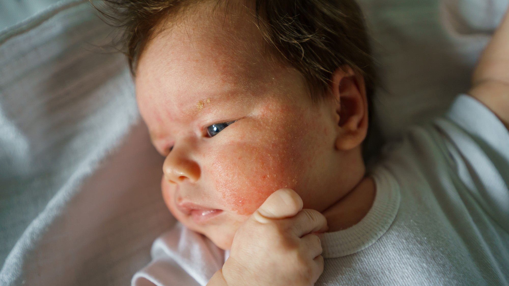 Svrbenie pokožky pri psoriáze: Rady a tipy, ako ho môžete zmierniť ...