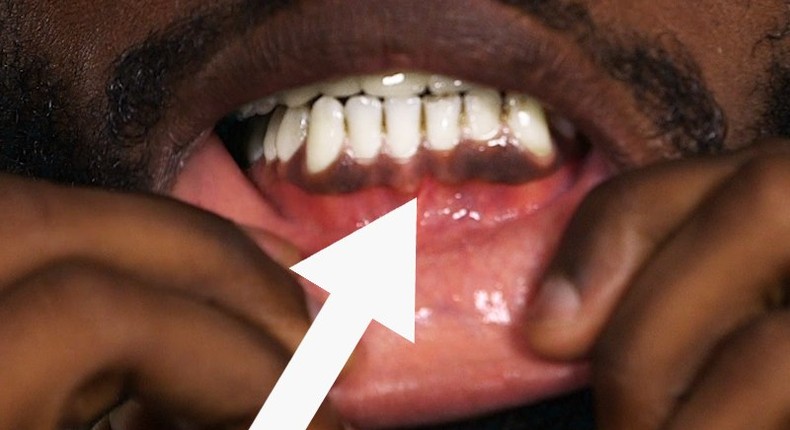 Here's why some people have black gums | Business Insider Africa