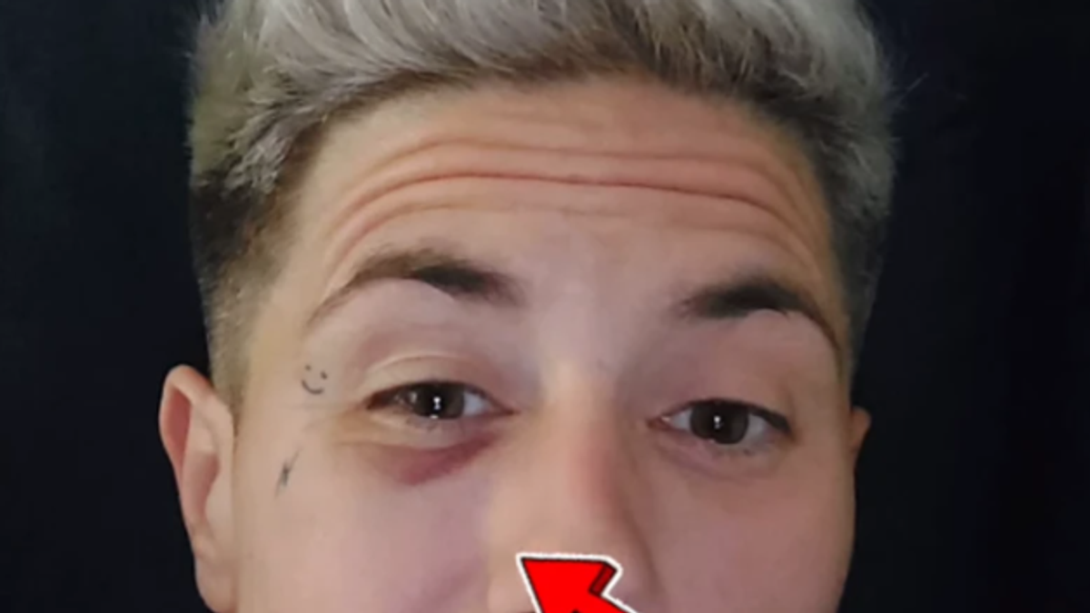 Matora sva u modricama, Ermina Pašović podelila stravične slike nakon svađe sa Stefani - Blic