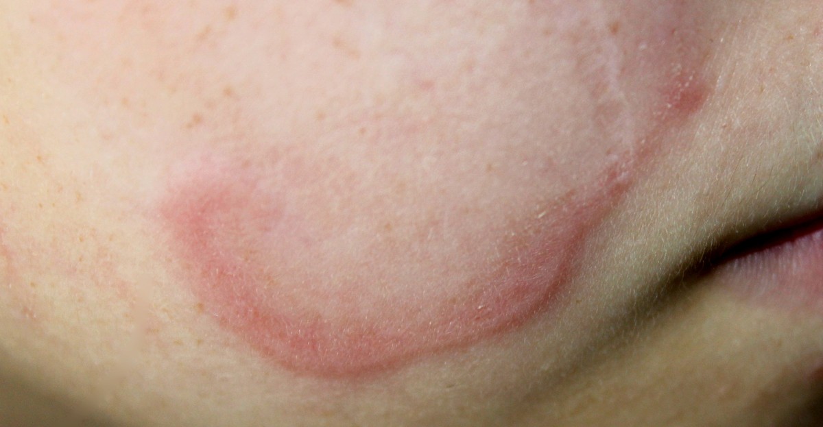 Liszaj na twarzy - przyczyny, objawy, leczenie. Domowe sposoby na liszaja