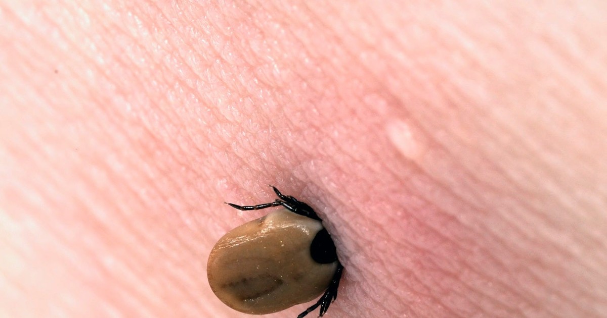 Tick-borne diseases are back. Here's the best way to check for tick ...