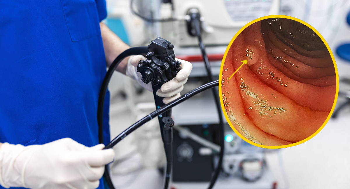 Polipy jelita grubego mogą być wstępem do raka jelita. Rodzaje polipów