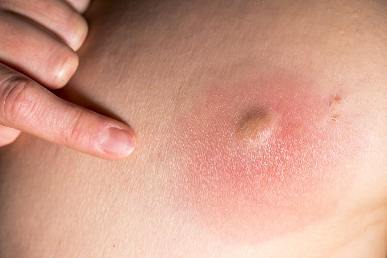 Mupirox - wskazania, dawkowanie, przeciwwskazania