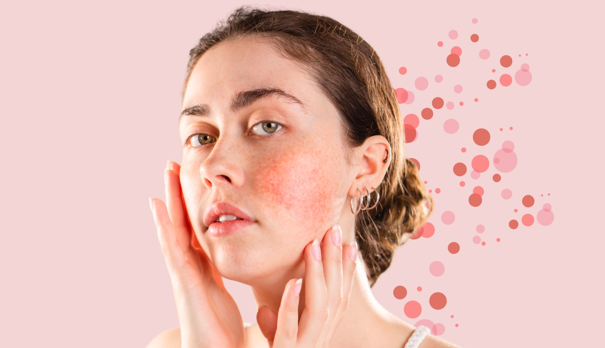 Mi az a rosacea és hogyan kezeld a szakértő szerint? - Glamour