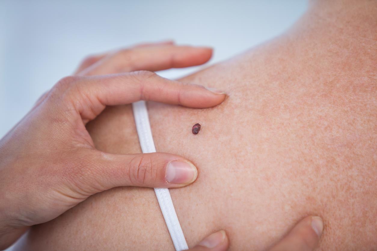 Dermatoskopia - mikroskopia powierzchni skóry, badanie znamion ...