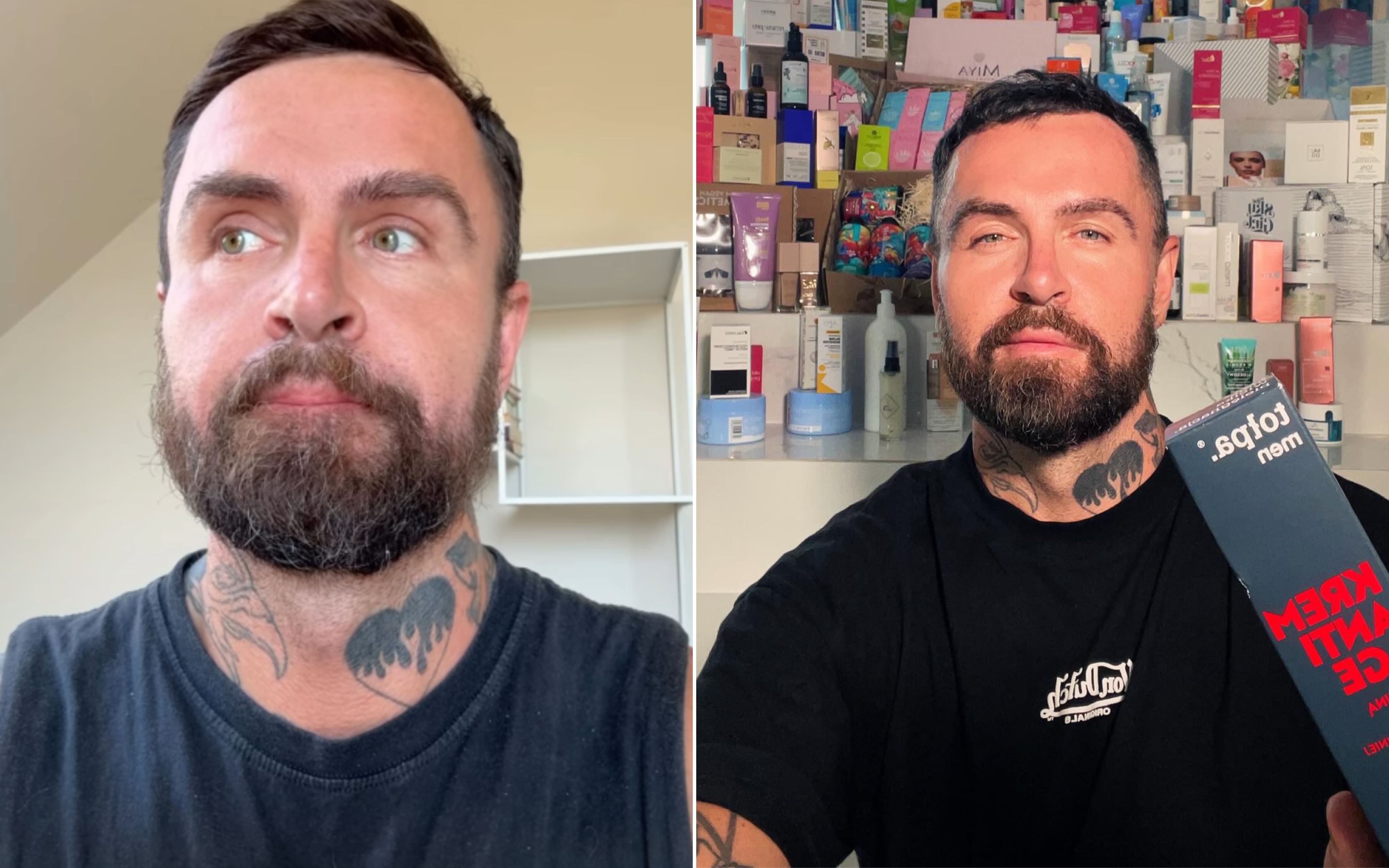 Fryzjer gwiazd, Łukasz Urbański usłyszał dramatyczną diagnozę. "To guz ...