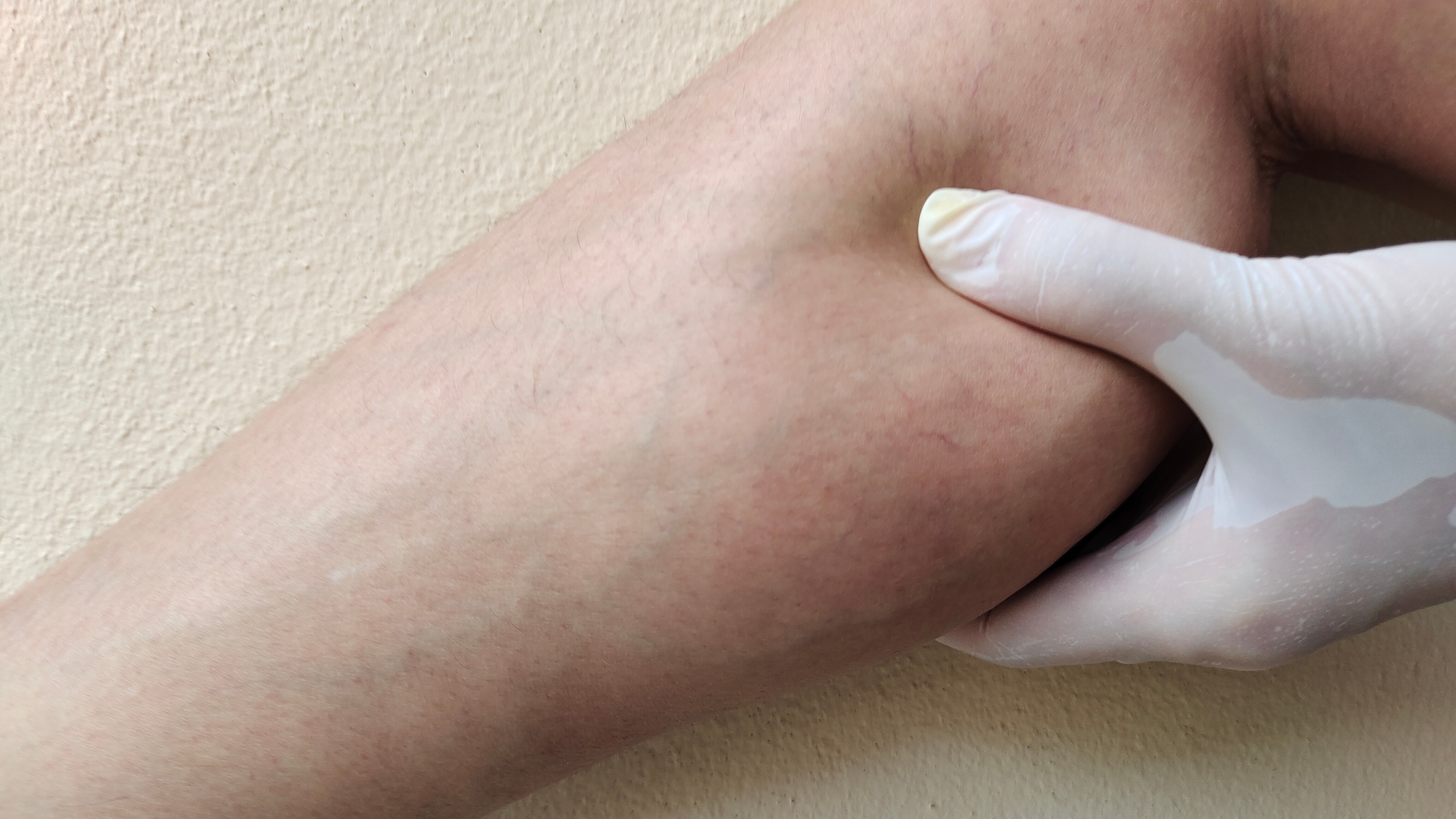 Oznaki lipodemii, których nie należy ignorować. Powodują silny ból