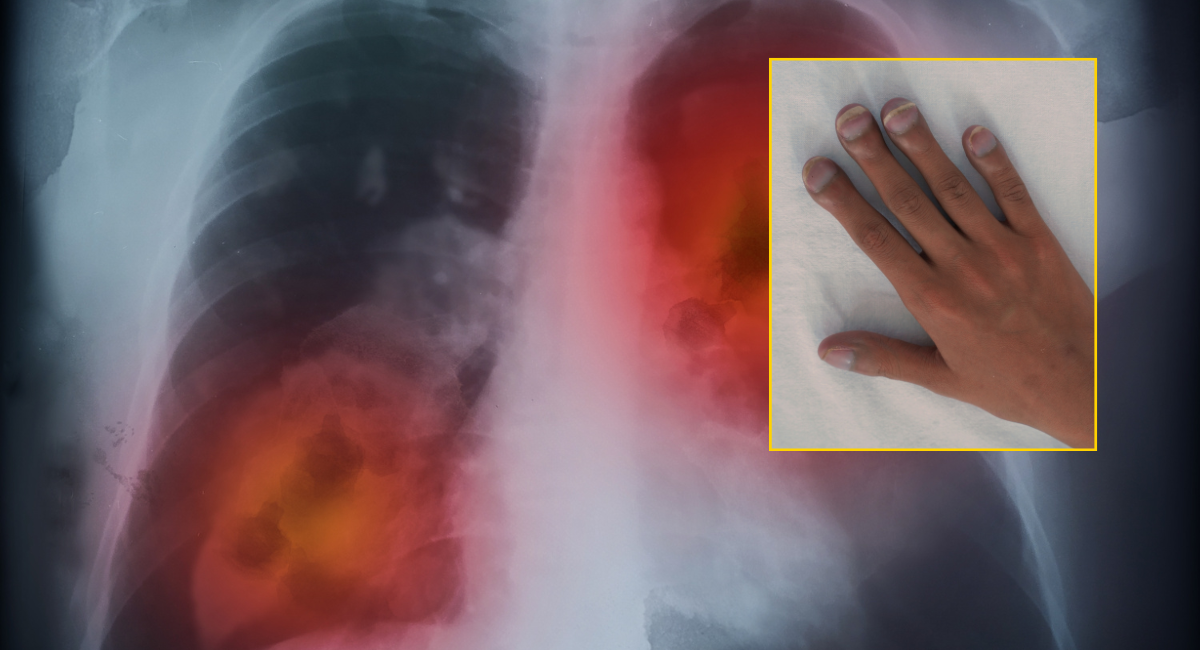 Nietypowy objaw raka płuc ma 35 proc. pacjentów. Wystarczy popatrzeć na ...