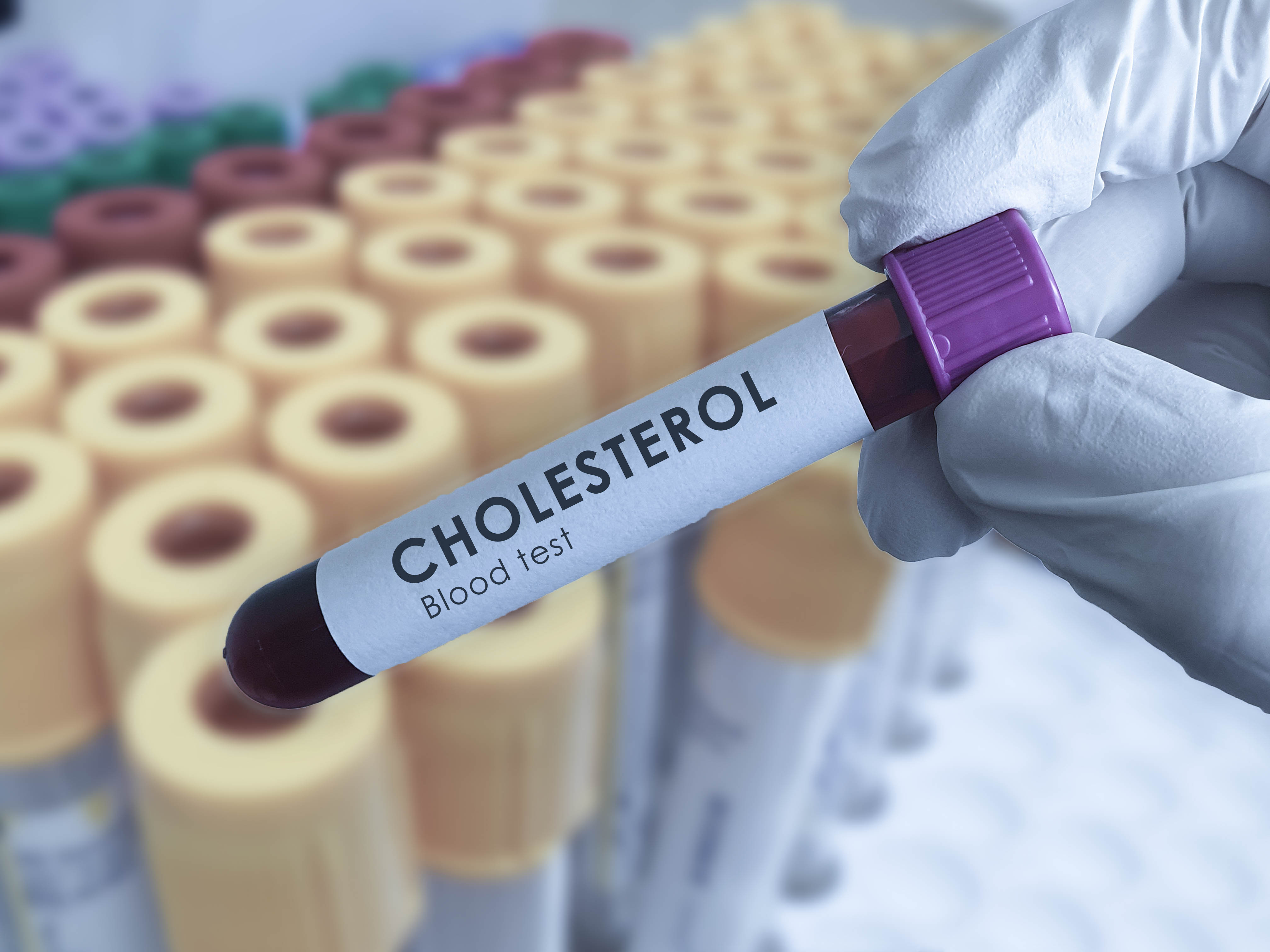 To ci "podbija" cholesterol. Czynniki, które podwyższają cholesterol