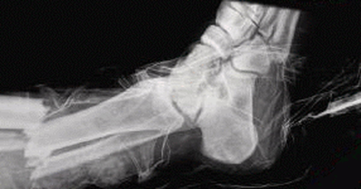 Rentgen złamanej nogi Marcina Wasilewskiego wygląda przerażająco ...