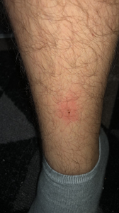 Czy to jest kleszcz? - Zapytaj.onet.pl