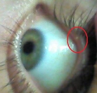 MAM COS NA OKU, wiecie moze co to jest? - Zapytaj.onet.pl