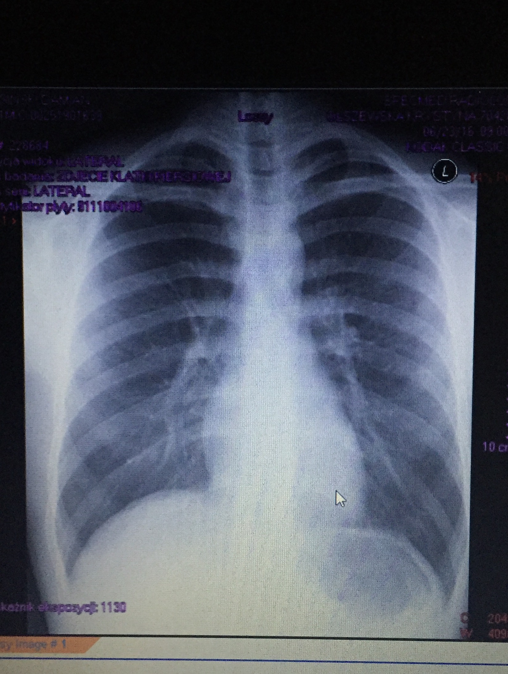 Rtg płuc prawidłowe? - Zapytaj.onet.pl